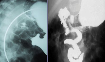 Definición de píloro | Chiapasparalelo